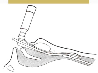 INTUBASI ENDOTRAKEAL | PPT