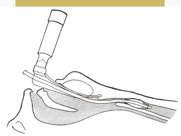 INTUBASI ENDOTRAKEAL | PPT