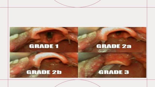 INTUBATION DR.MANISHA(RSI & DSI).pptx ppt | PPTX | First Aid | Injuries