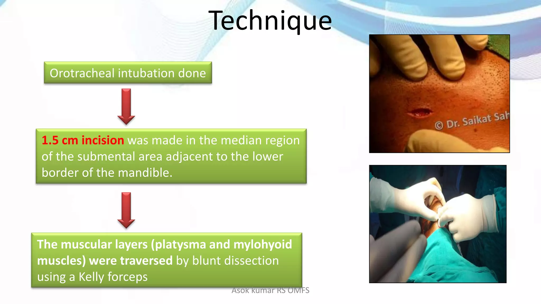 Intubation in omfs | PDF