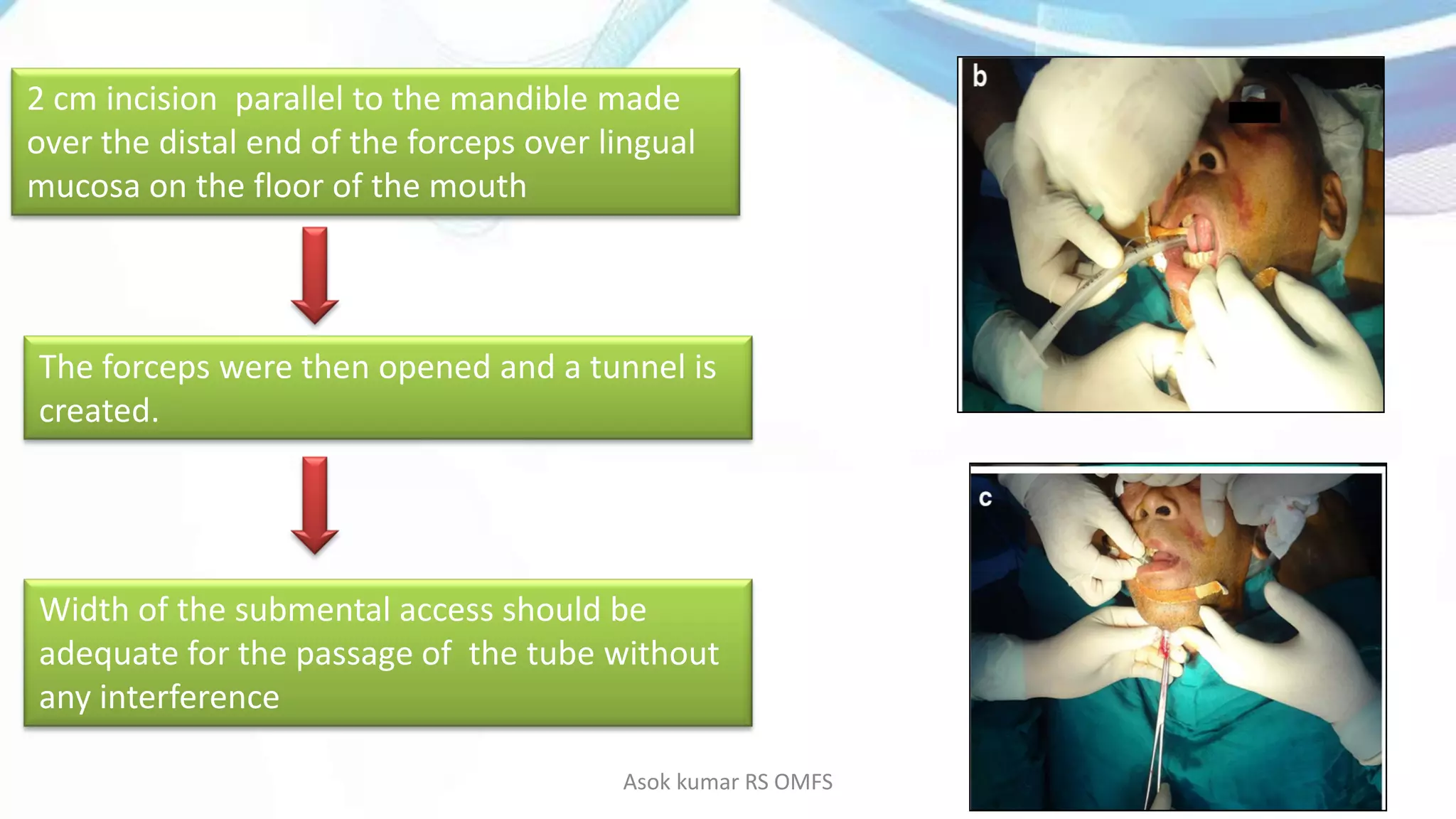 Intubation in omfs | PDF