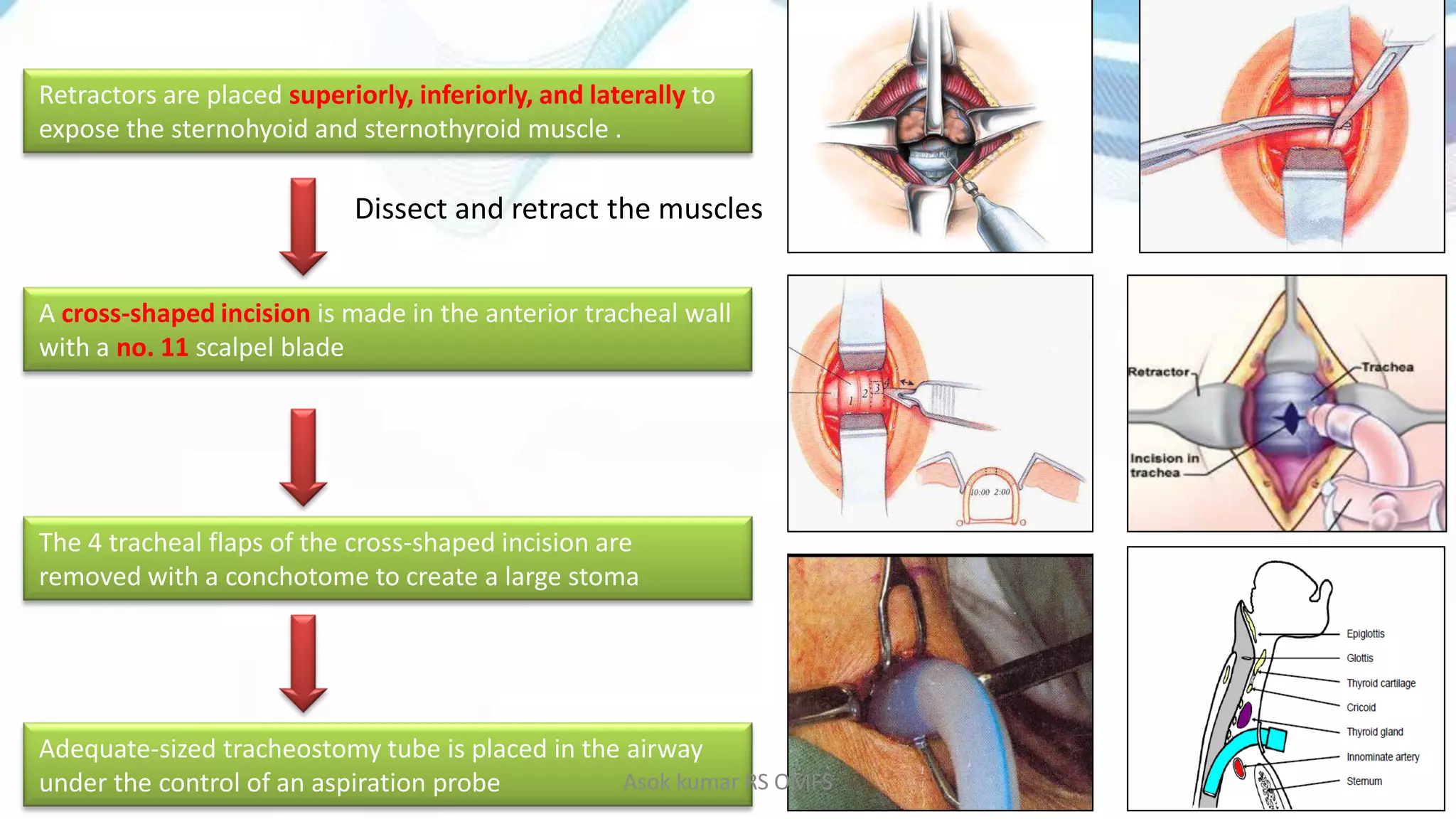 Intubation in omfs | PDF