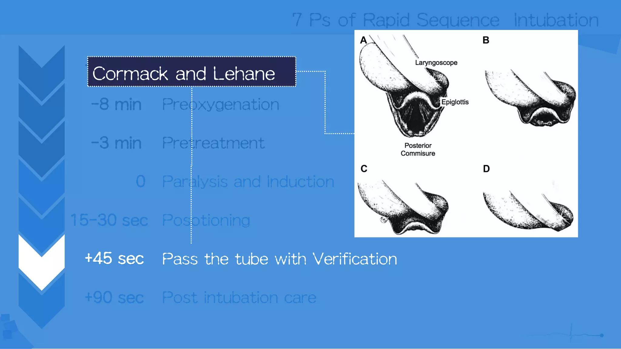 病房插管小筆記 (Note about Rapid sequence intubation) | PDF