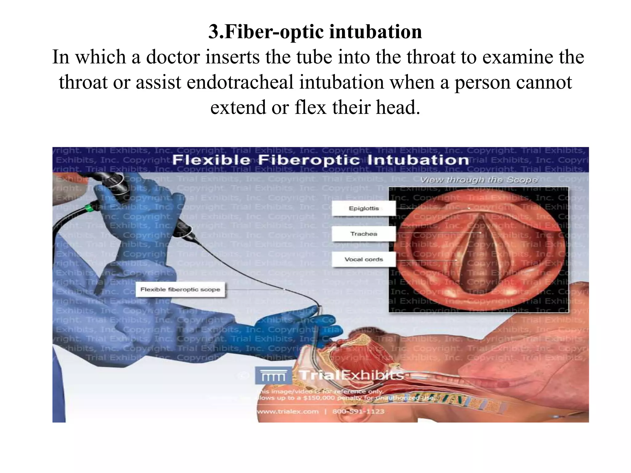 Intubation ppt | PPTX | First Aid | Injuries