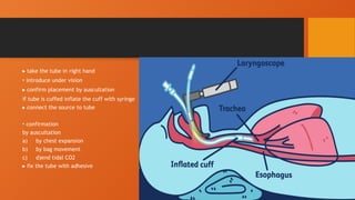 intubation project for seminar. ppt.pptx