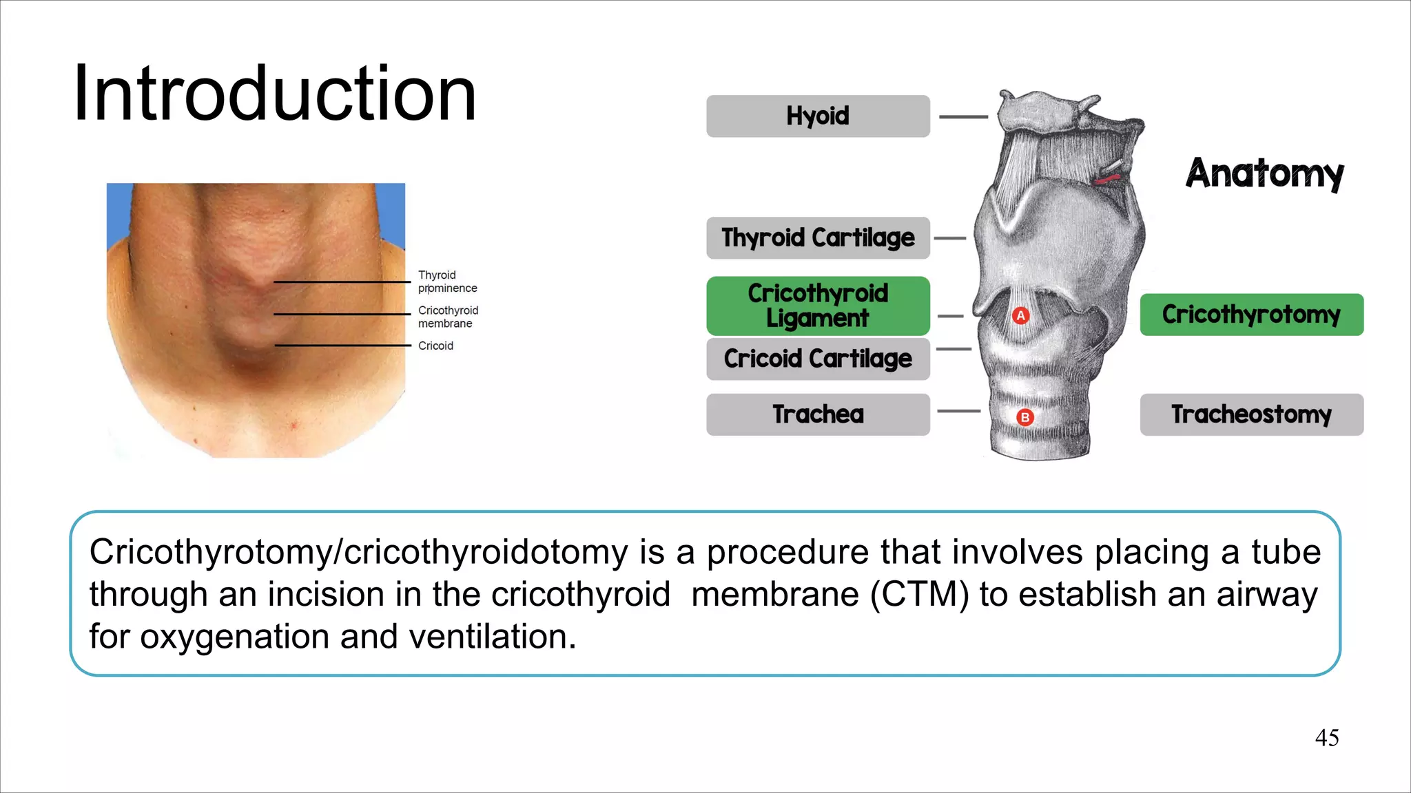 Intubation, Tracheostomy,Cricothyroidotomy.pdf