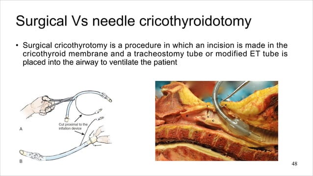 Intubation, Tracheostomy,Cricothyroidotomy.pdf
