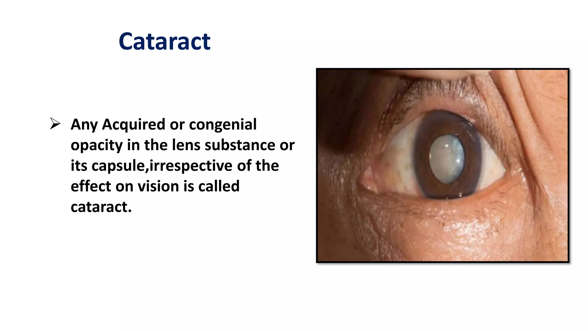 intumescent cataract_4138fe68-5bac-46d7-91e9-2d309ef41da2.pptx