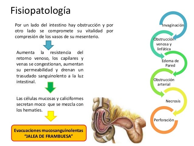 Intuscepcion o invaginacion intestinal