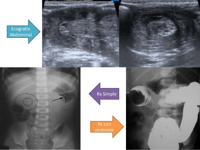 Intuscepcion O Invaginacion Intestinal intuscepcion-o-invaginacion-intestinal