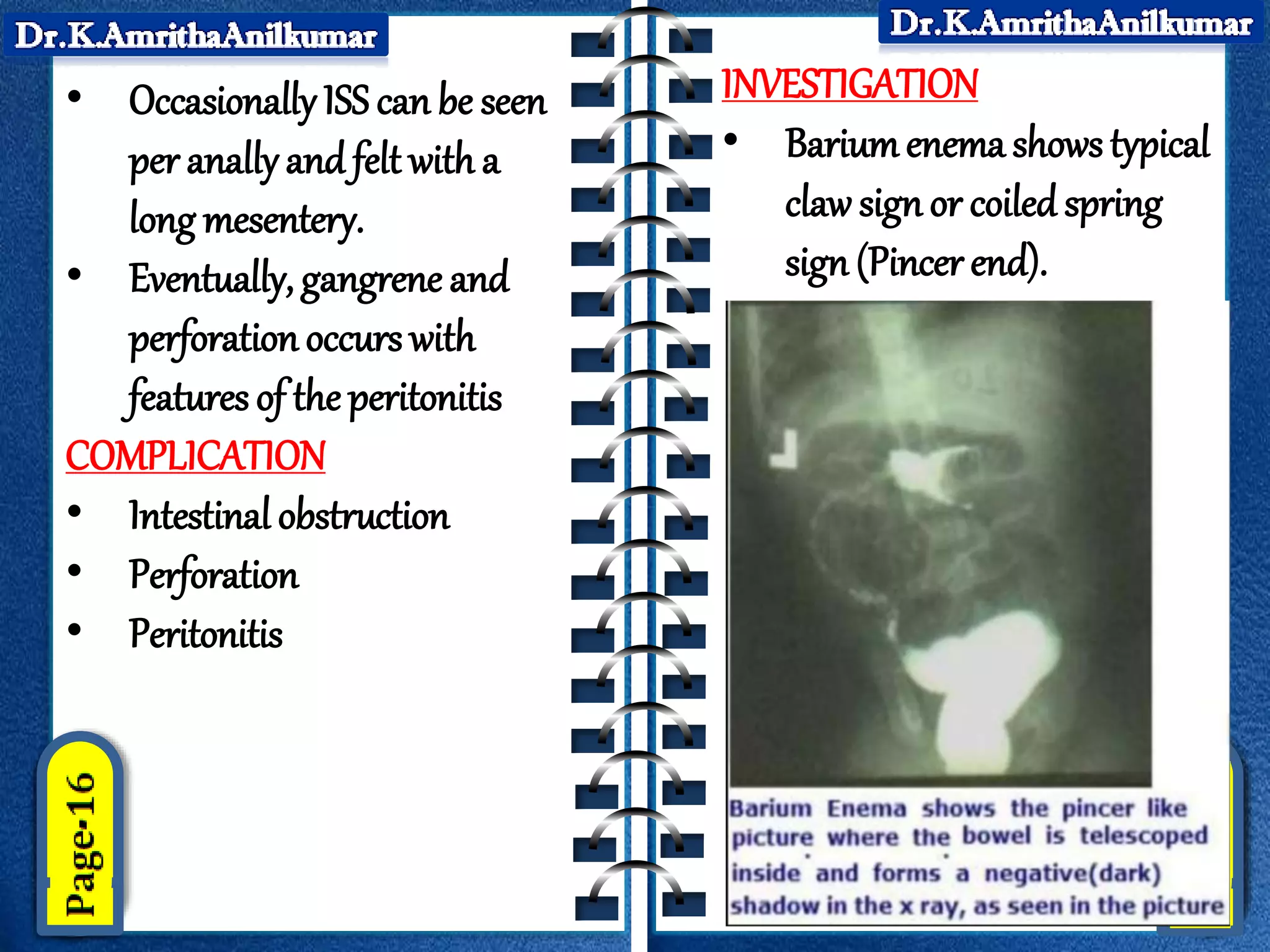 Intussusception by Dr.AmrithaAnilkumar | PPTX
