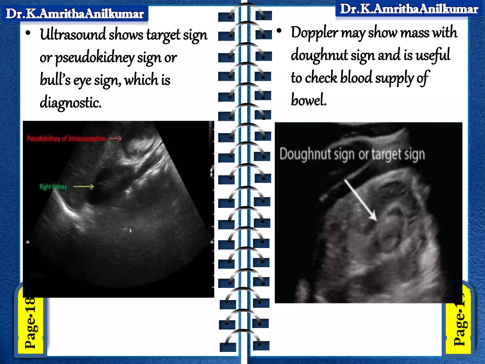 Intussusception by Dr.AmrithaAnilkumar | PPTX