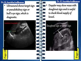 Intussusception by Dr.AmrithaAnilkumar | PPTX | Digestive Disorders ...