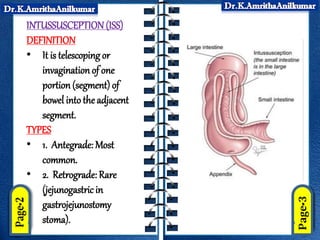 Intussusception by Dr.AmrithaAnilkumar | PPTX | Digestive Disorders ...