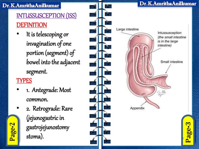 Intussusception by Dr.AmrithaAnilkumar | PPT