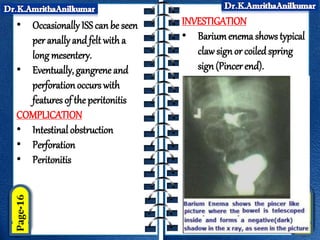 Intussusception Barium Enema Claw Sign
