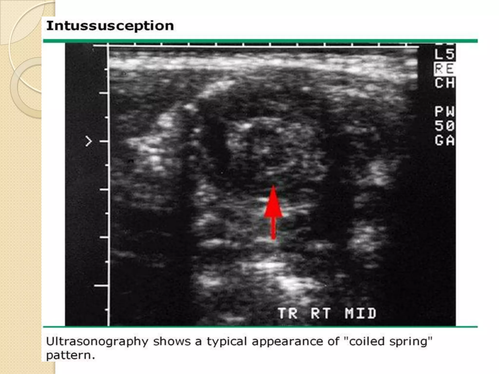 Intussusception in children | PPTX