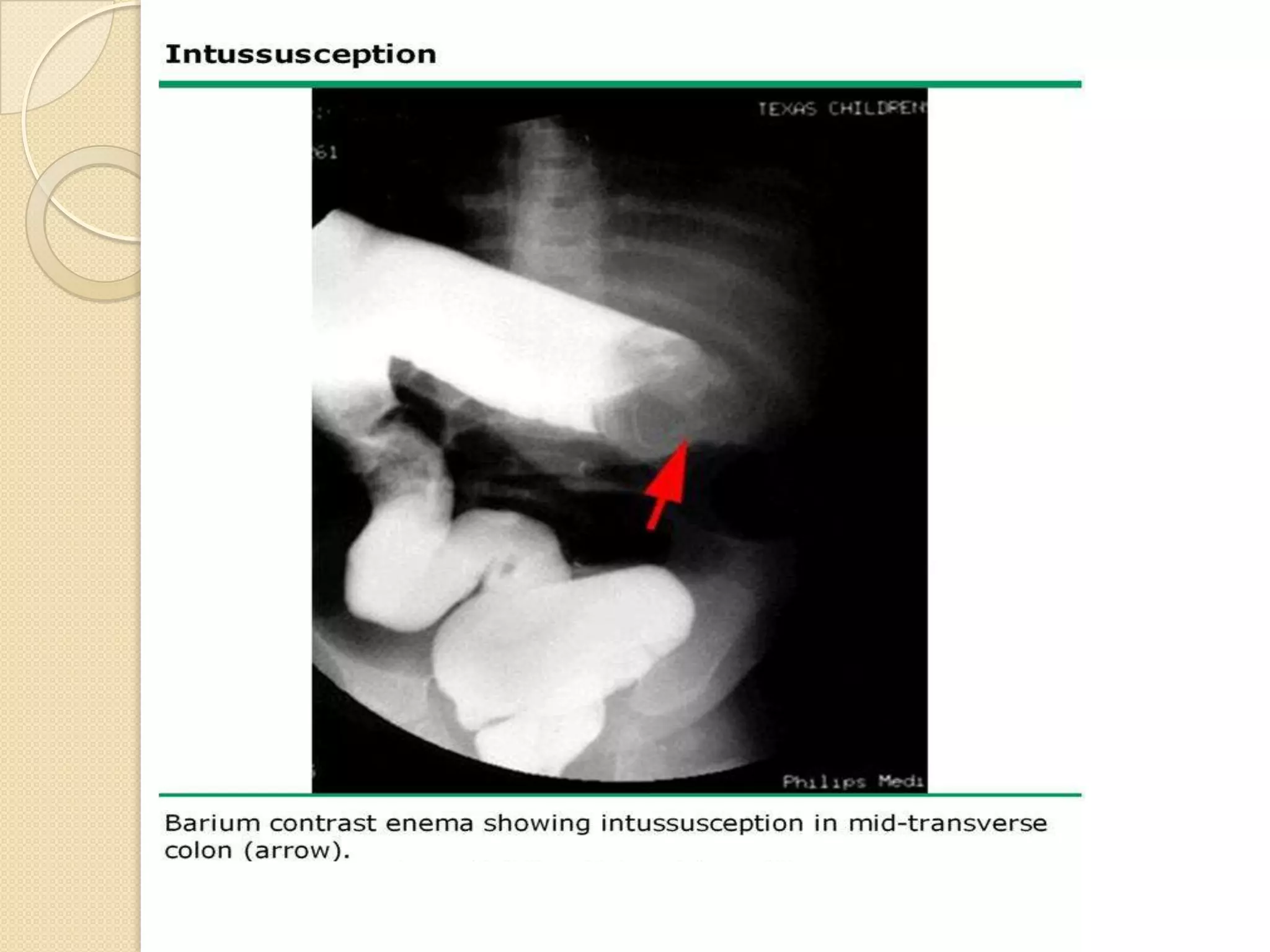 Intussusception in children | PPTX