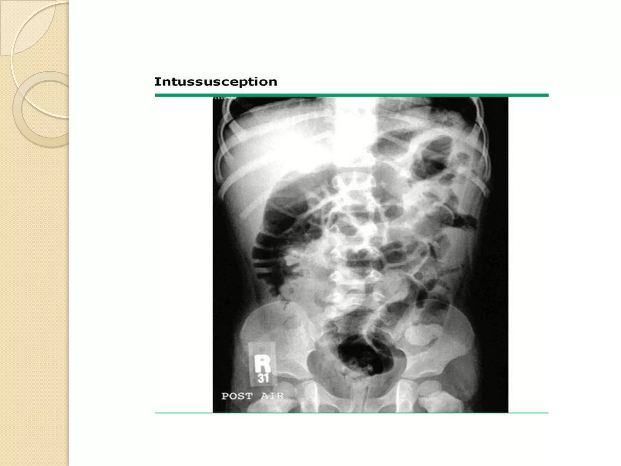 Intussusception in children | PPTX