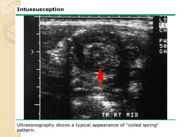 Intussusception in children | PPTX