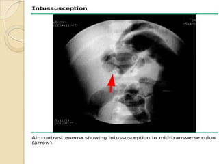 Intussusception in children | PPTX