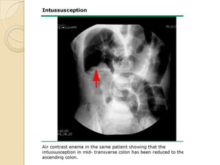 Barium Enema Intussusception