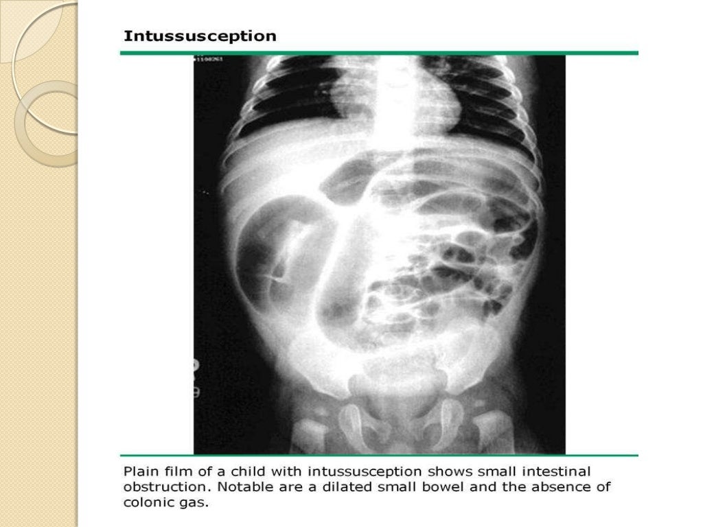 Intussusception in children