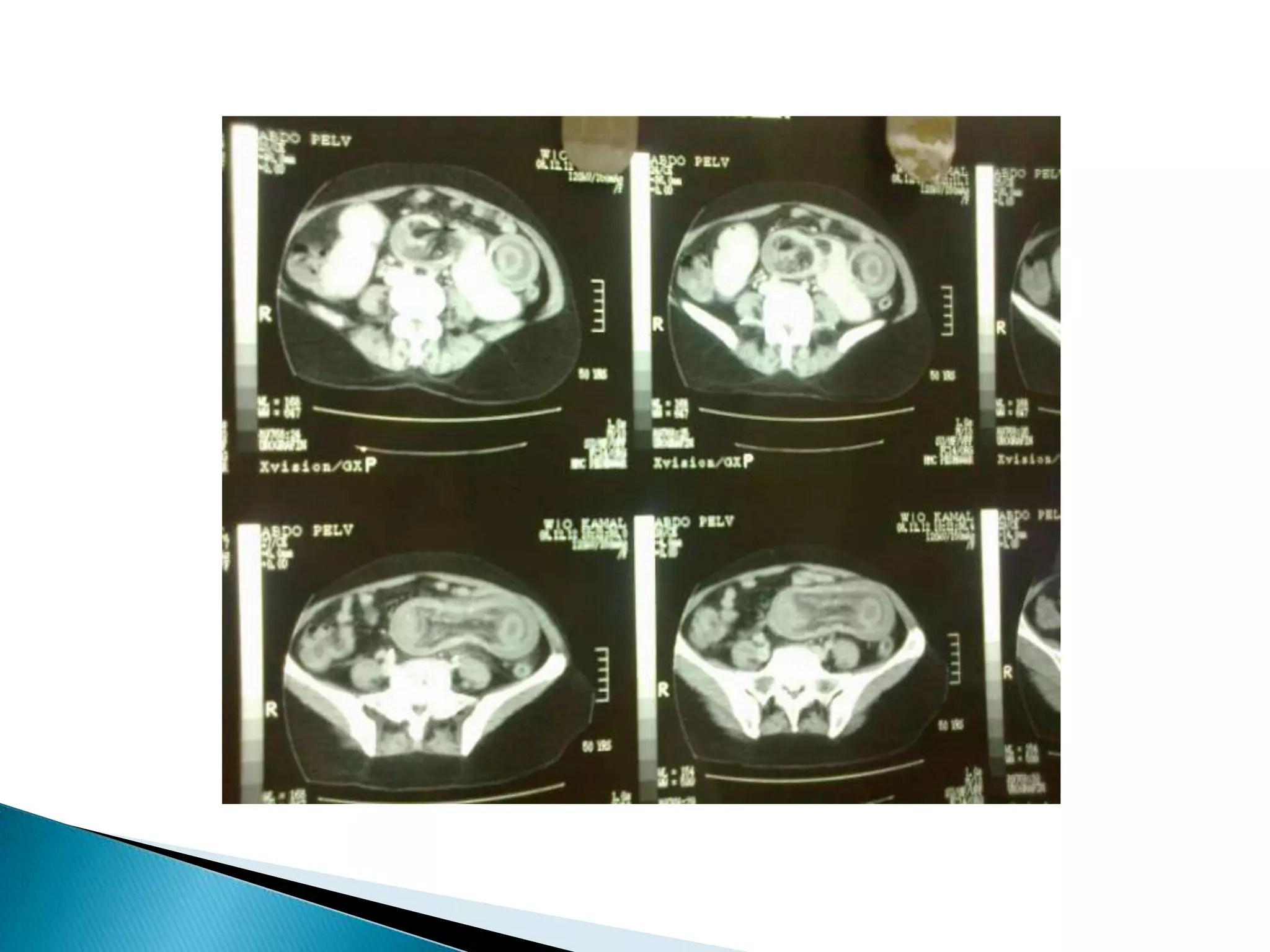 Intussusception | PPT