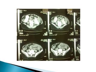 Intussusception | PPT