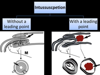 Intussusception | PPTX | Digestive Disorders | Diseases and Conditions
