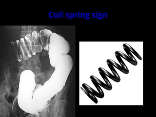 Coil Spring Symbol
