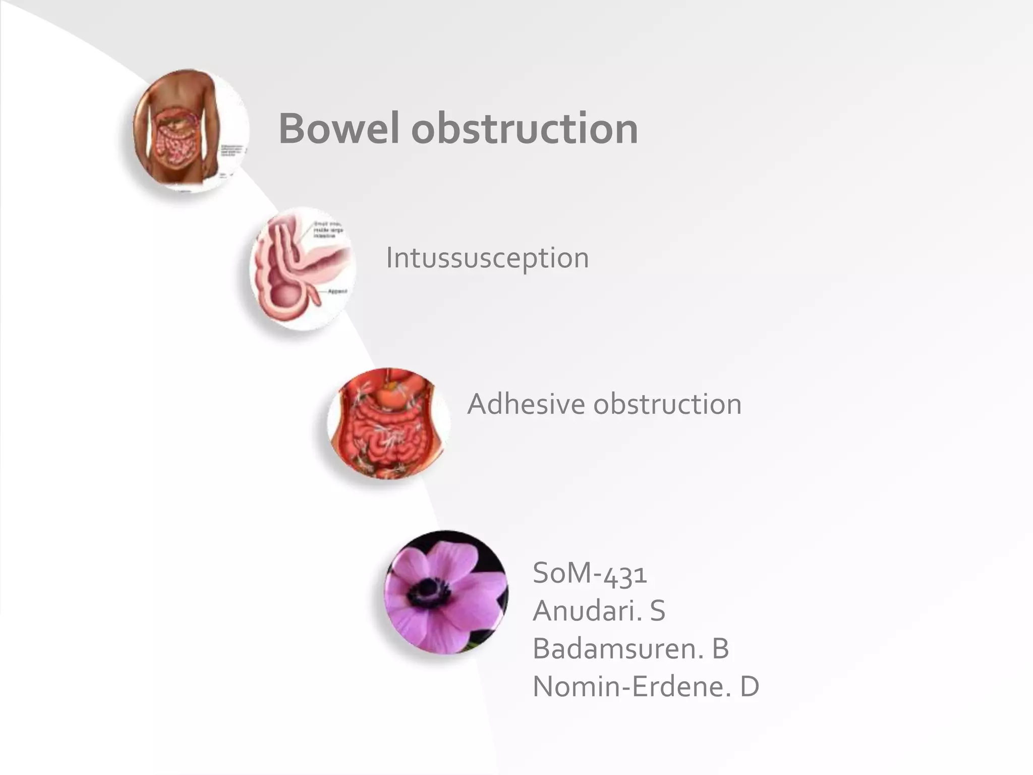 Intussusception | PPT
