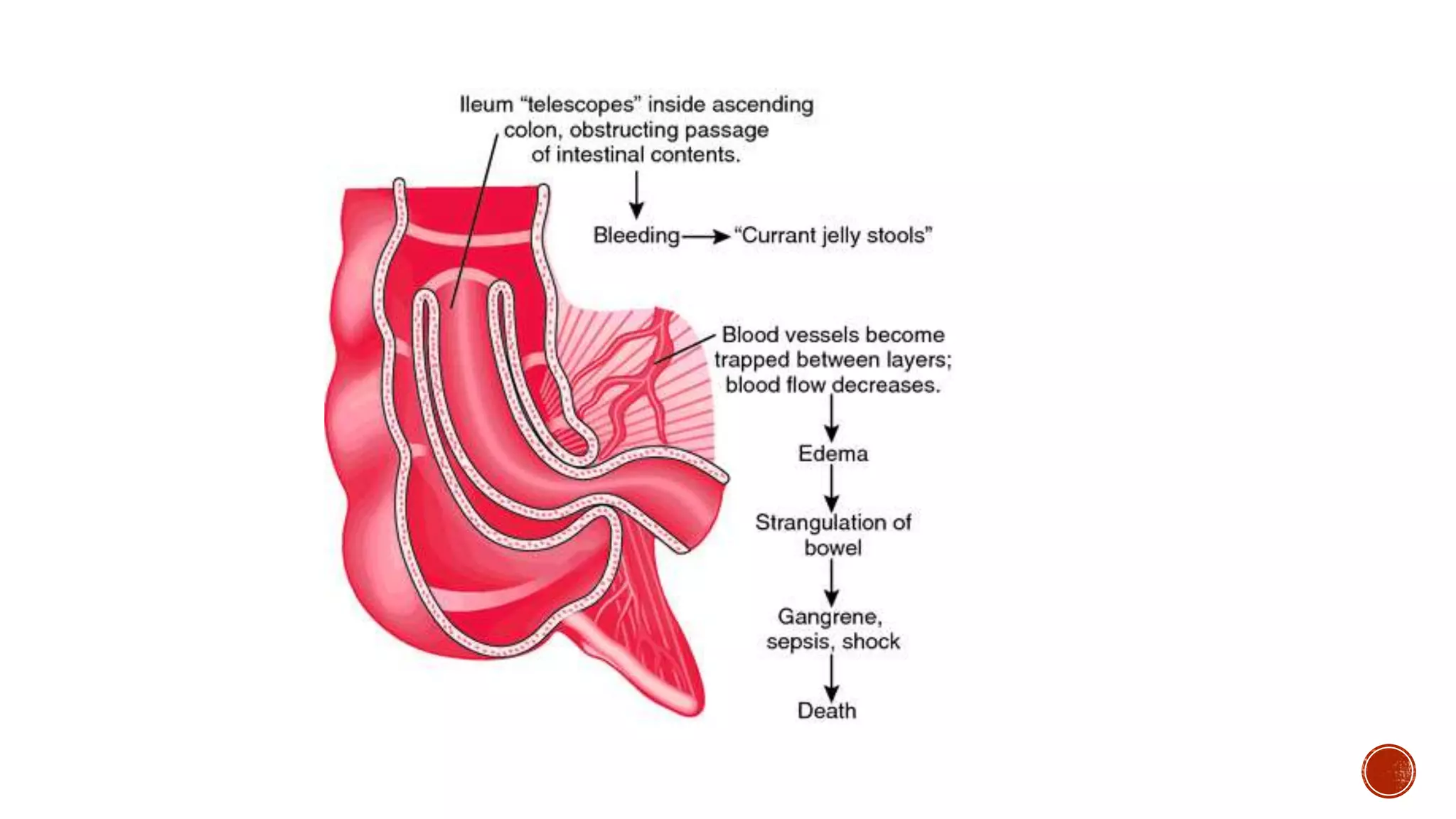 Intussusception | PPT | Free Download