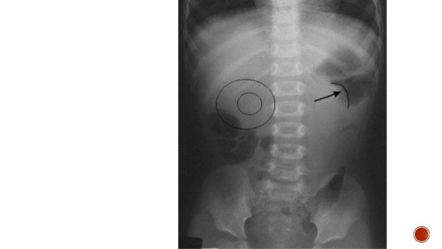 Intussusception