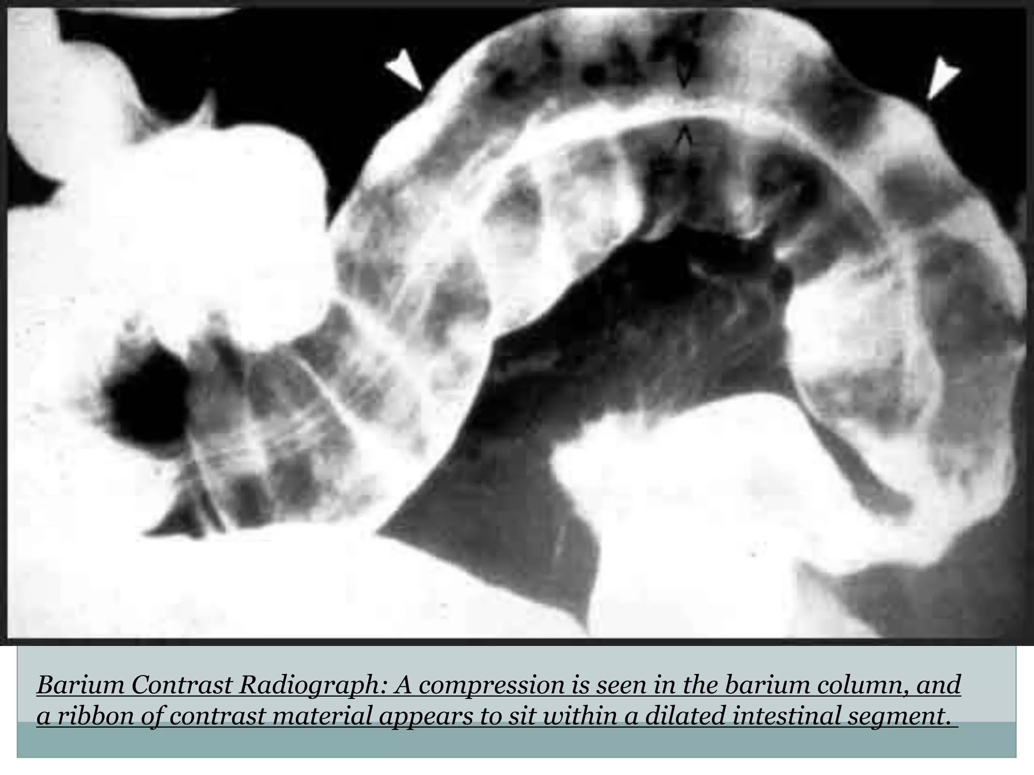 Intussusception in cattle | PPTX