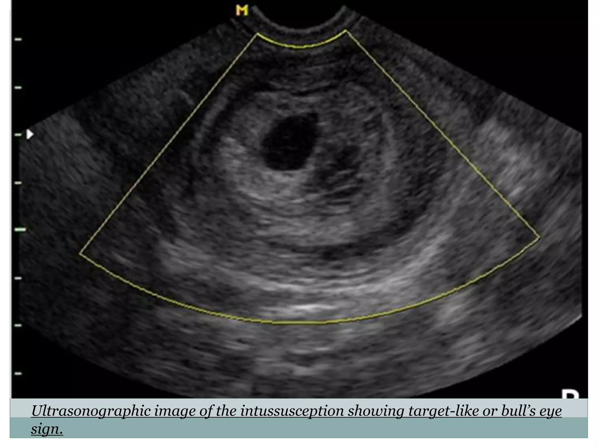 Intussusception in cattle | PPTX