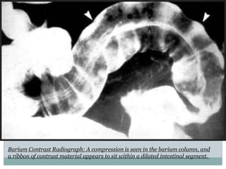 Intussusception in cattle | PPTX