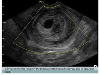 Intussusception in cattle | PPTX