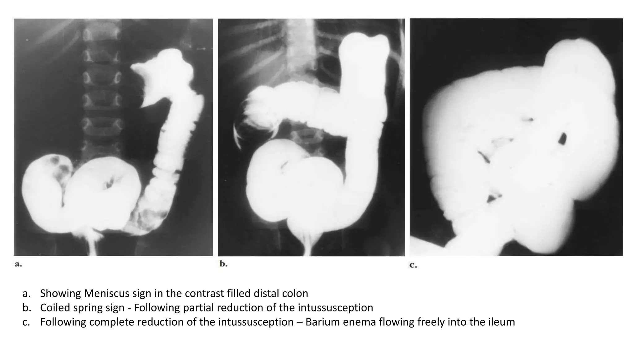Intussusception - A Comprehensive Presentation | PPTX