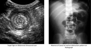 Intussusception - A Comprehensive Presentation | PPTX