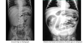 Intussusception - A Comprehensive Presentation | PPTX