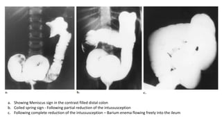 Intussusception - A Comprehensive Presentation | PPTX