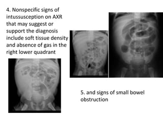 Intussusception | PPTX | Digestive Disorders | Diseases and Conditions