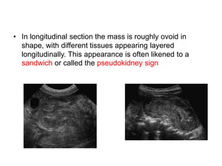 Intussusception | PPTX | Digestive Disorders | Diseases and Conditions