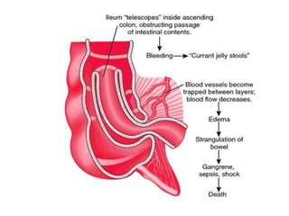 Intussusception | PPTX | Digestive Disorders | Diseases and Conditions