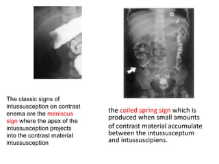 Barium Enema Intussusception