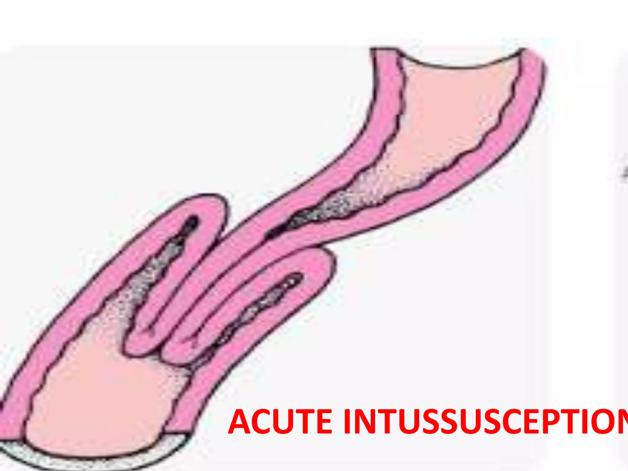 INTUSSUSCEPTION.pptx
