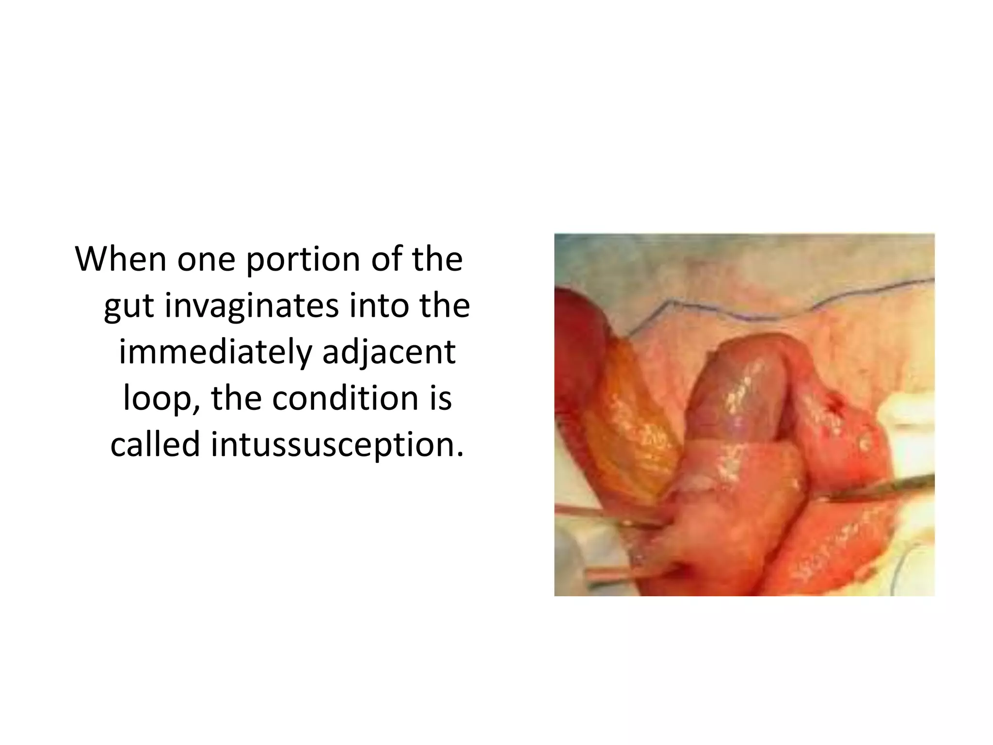 INTUSSUSCEPTION.pptx