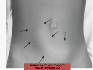 INTUSSUSCEPTION.pptx