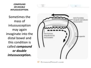 INTUSSUSCEPTION.pptx